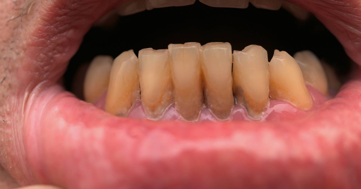 Slecht gebit door eigen schuld | DDS