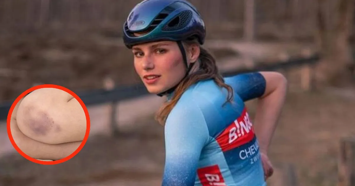 Puck Moonen toont pijnlijke knietjes op heftige foto