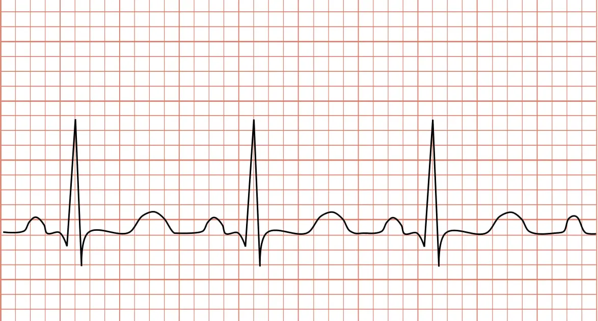 Hartkloppingen centraal tijdens tweede Hart & Vaatcafé