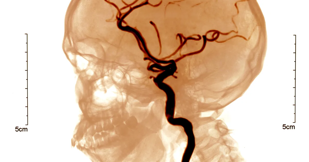 Symptomen: zo voel je een hersenbloeding aankomen