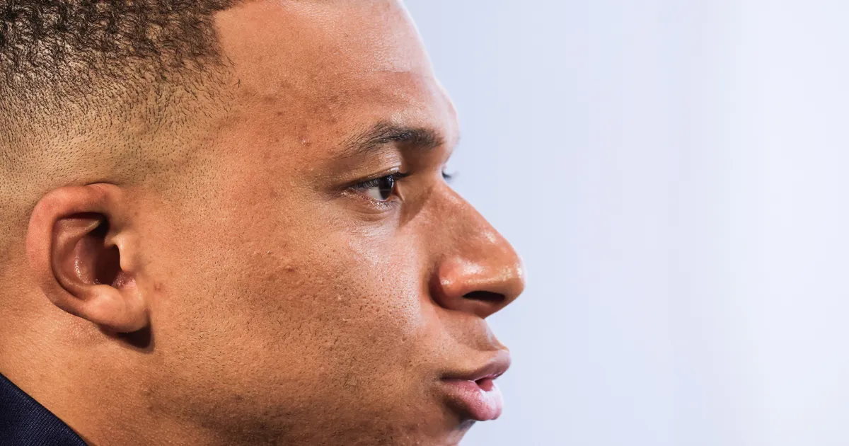 Wat is een gebroken neus? En is het erg?