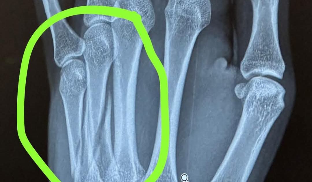 Worst breaks two hand bones and undergoes surgery after painful crash ...
