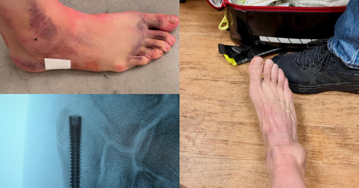📸 Van Aert takes first 'victory' on the bike in 2026, but photos of ankle fracture prove ...