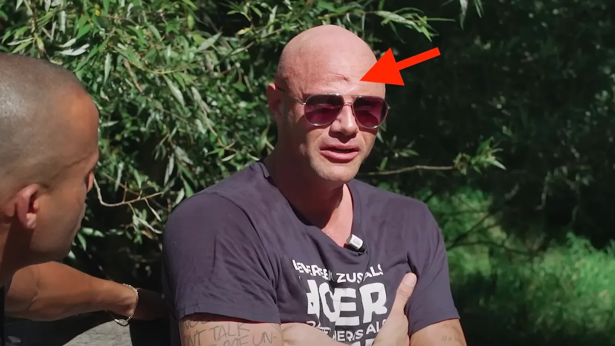 Alex Soze legt uit hoe hij aan die deuk in zijn harses komt | LOESOE