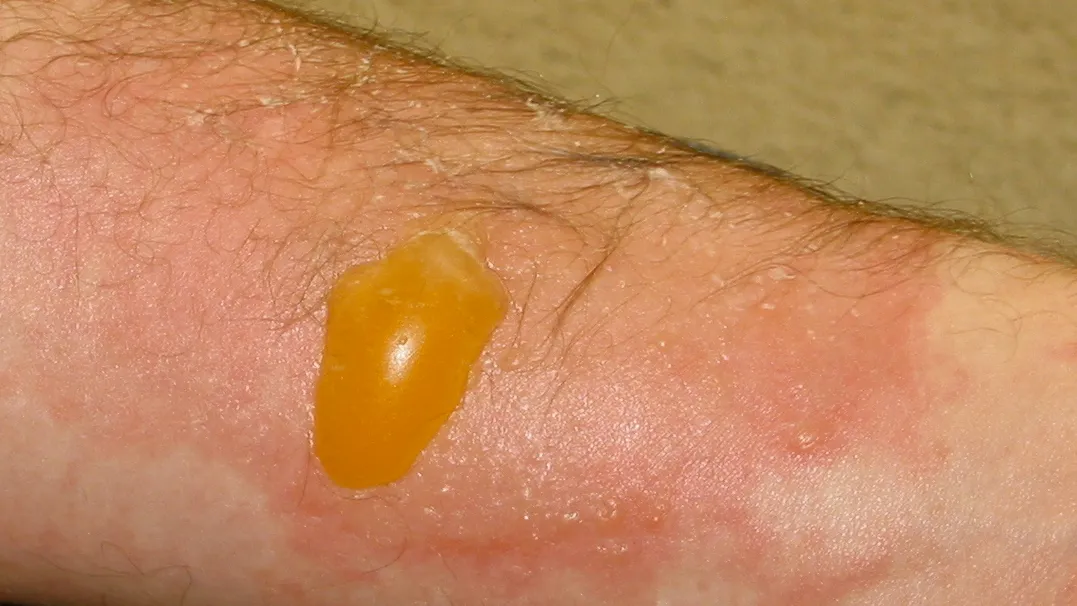 Nieuwe methode helpt bij genezing brandwonden