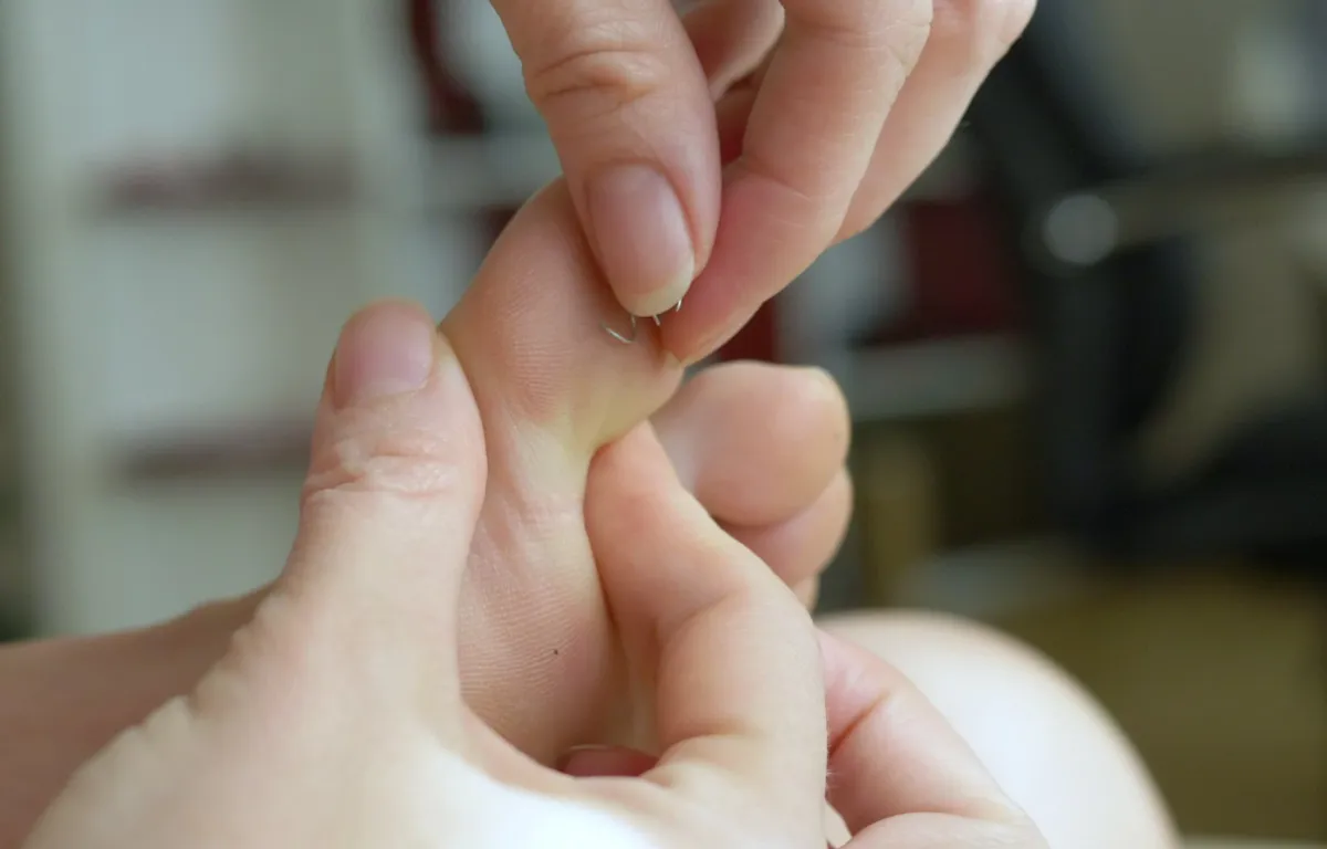 Hoe je makkelijk een splinter verwijdert