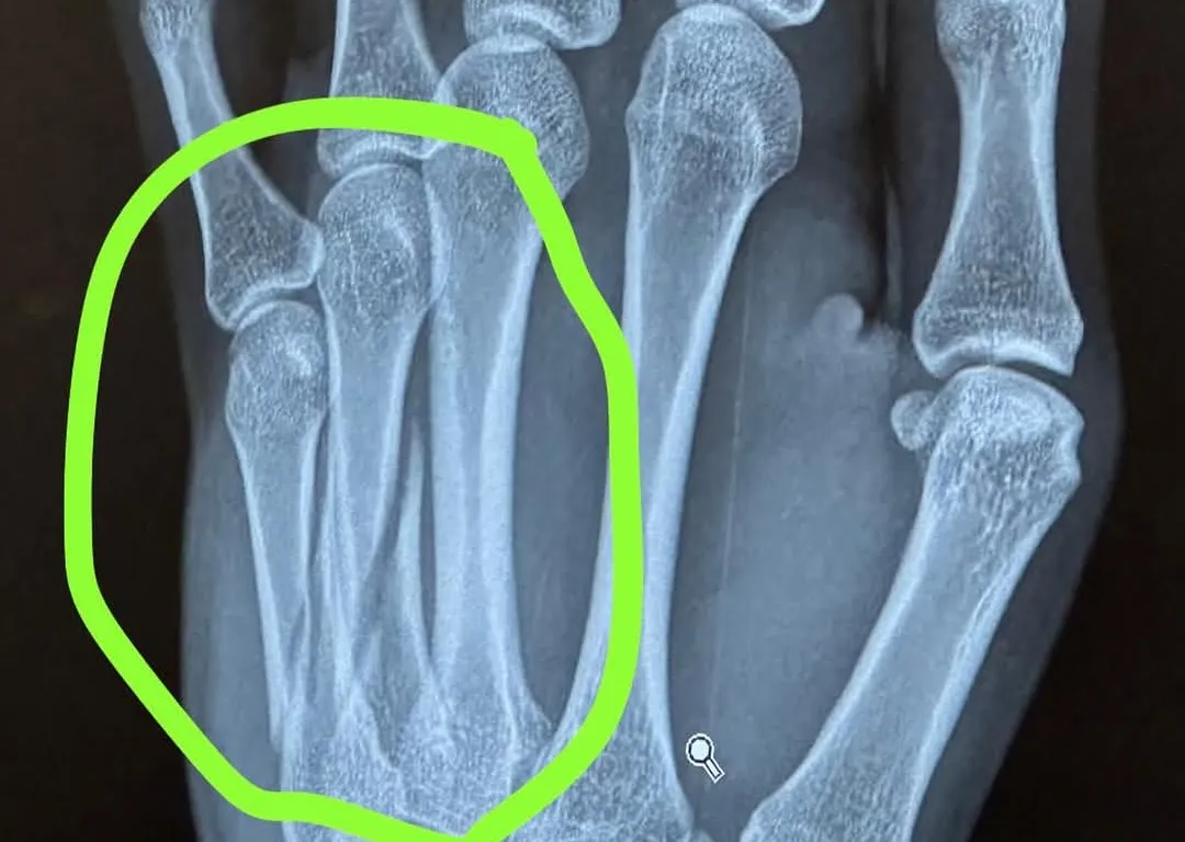 Worst breaks two hand bones and undergoes surgery after painful crash ...
