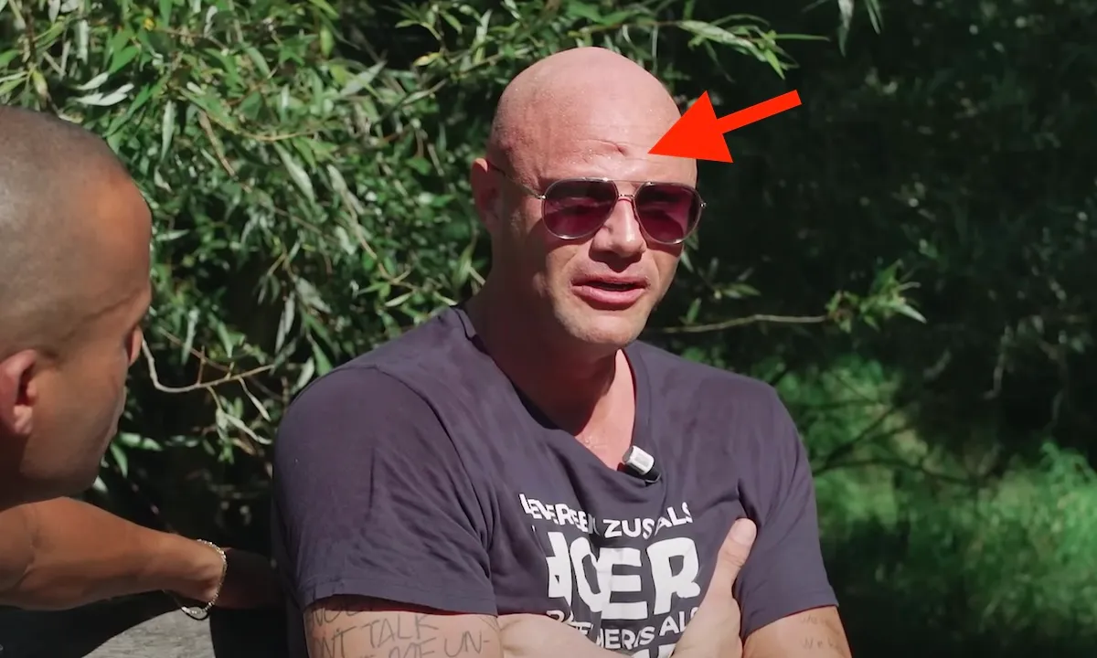 Alex Soze legt uit hoe hij aan die deuk in zijn harses komt | LOESOE