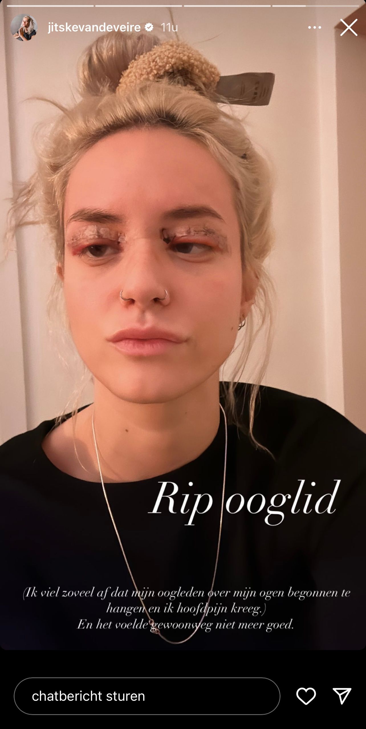Jitske Van de Veire laat esthetische ingreep uitvoeren en toont ...