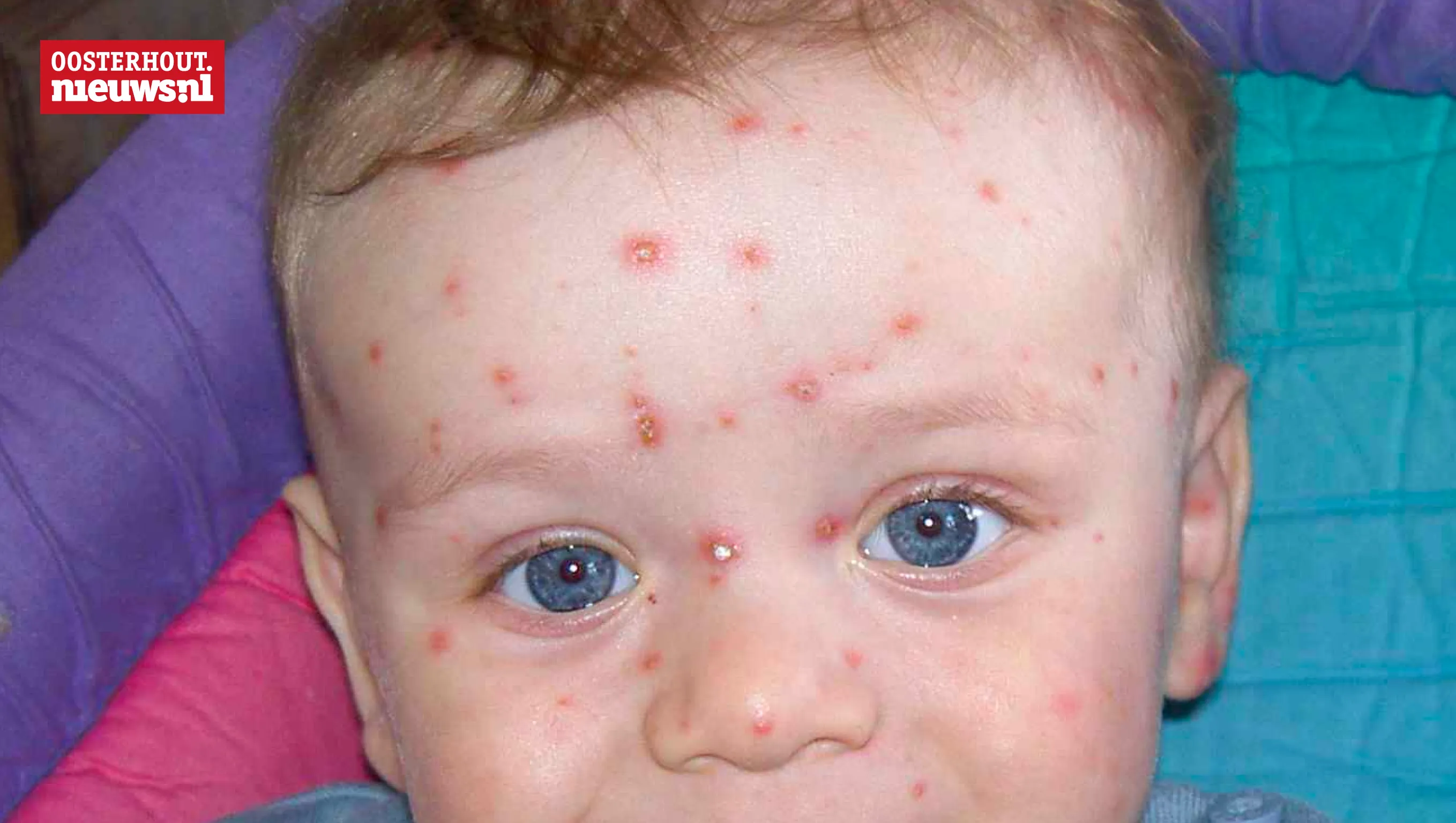 Onderzoekers zien grote toename van waterpokken onder kinderen