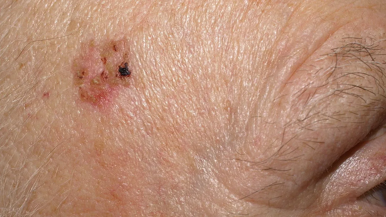 Nieuwe huidkankercampagne: vroege ontdekking blijft belangrijk